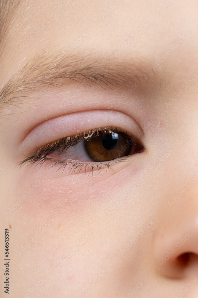 Eye of a child with conjunctivitis, inflammation of the conjunctiva ...