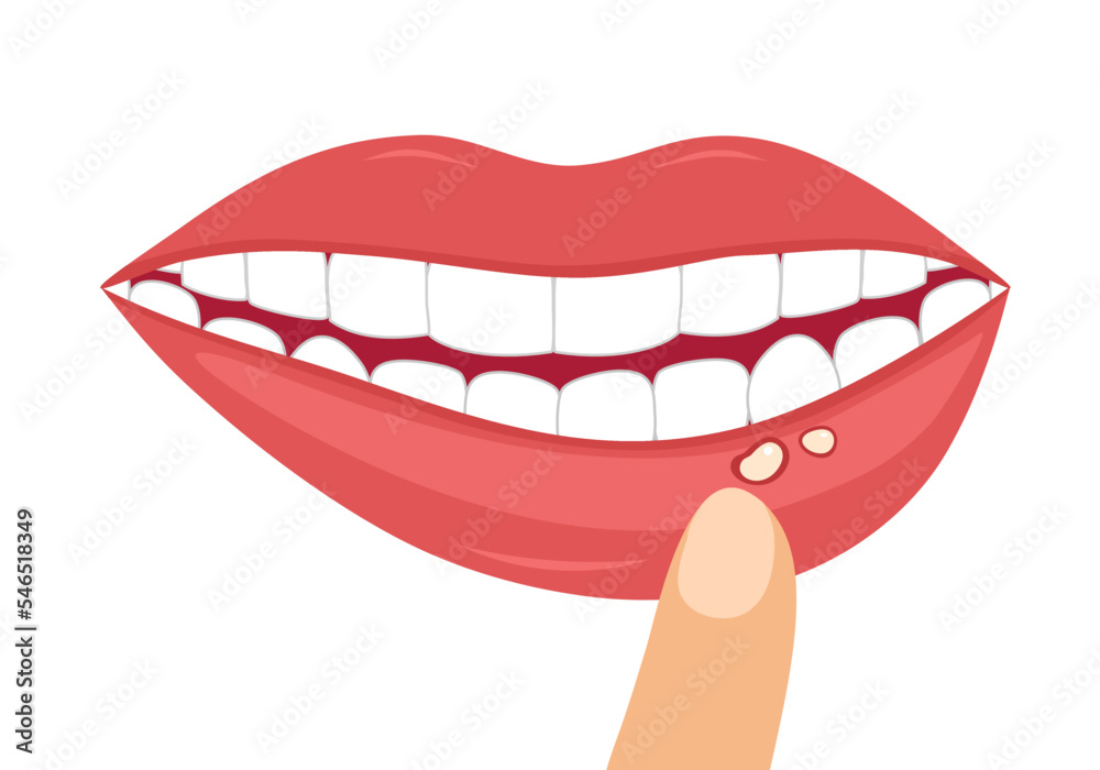 Poster Mouth ulcer concept vector illustration on white background ...
