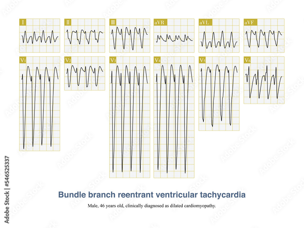 Bundle branch reentrant tachycardia is a life critical ventricular ...