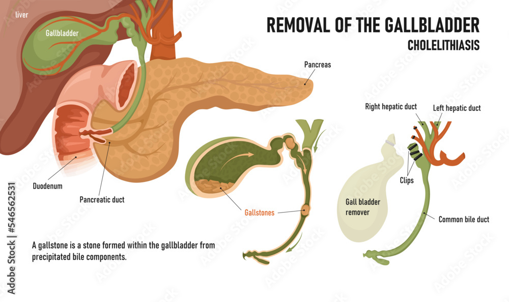 Cholecystitis. Inflammation of the gallbladder and bile ducts ...