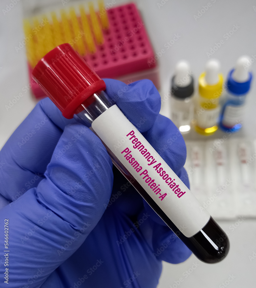 Blood sample for Pregnancy-associated plasma protein-A(PAPP-A) test ...