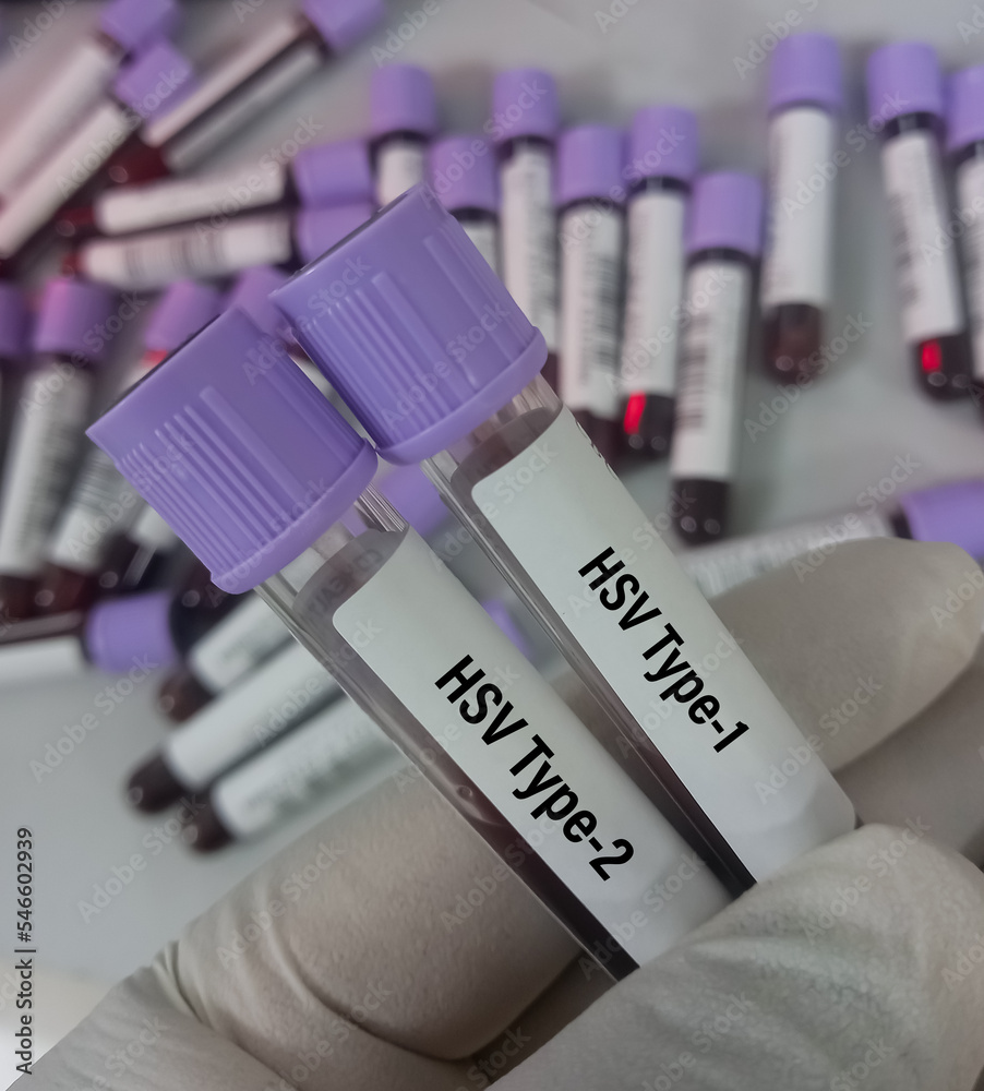Blood sample HSV (type1 and 2) test to detect Herpes simplex virus ...