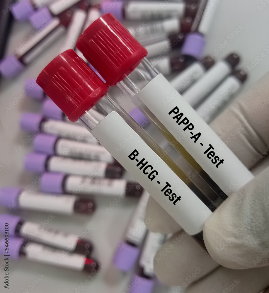 Blood sample for PAPP-A and Free B-HCG test for Down syndrome and ...