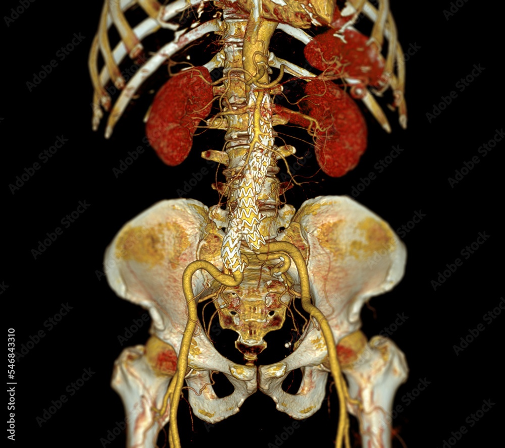 Cta Whole Aorta With Abdominal Aorta Stent Graft Compare 3d Rendering Image Stock Illustration