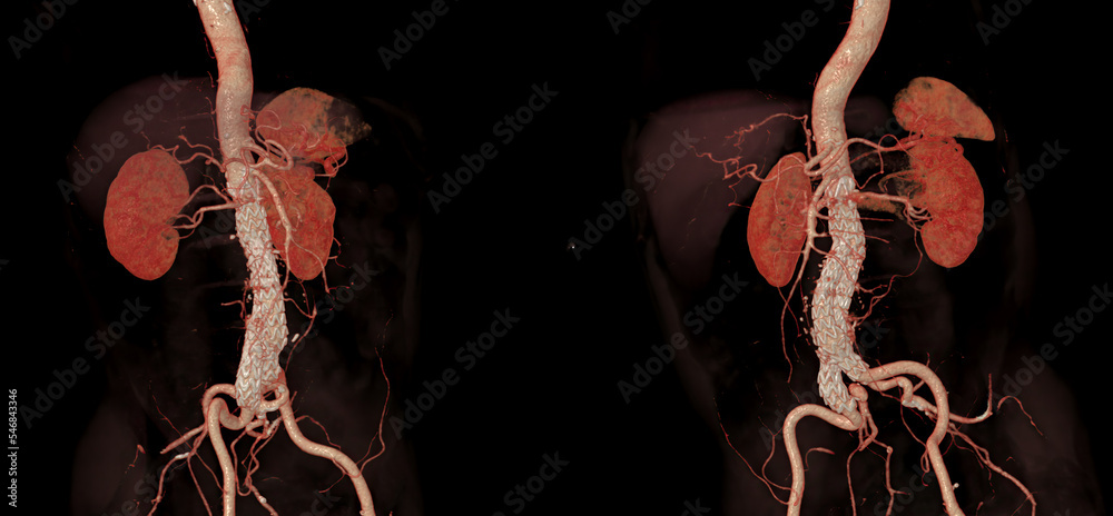 Poster CTA whole aorta with Abdominal aorta stent graft compare 3D ...