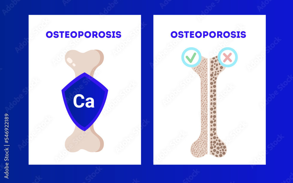 Osteoporosis vector posters. Medical orthopaedic posters with an ...