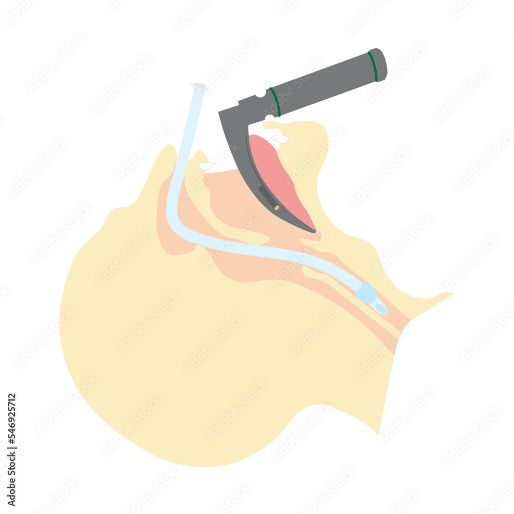 Nasotracheal intubation illustration. Laryngoscopy with intubation ...