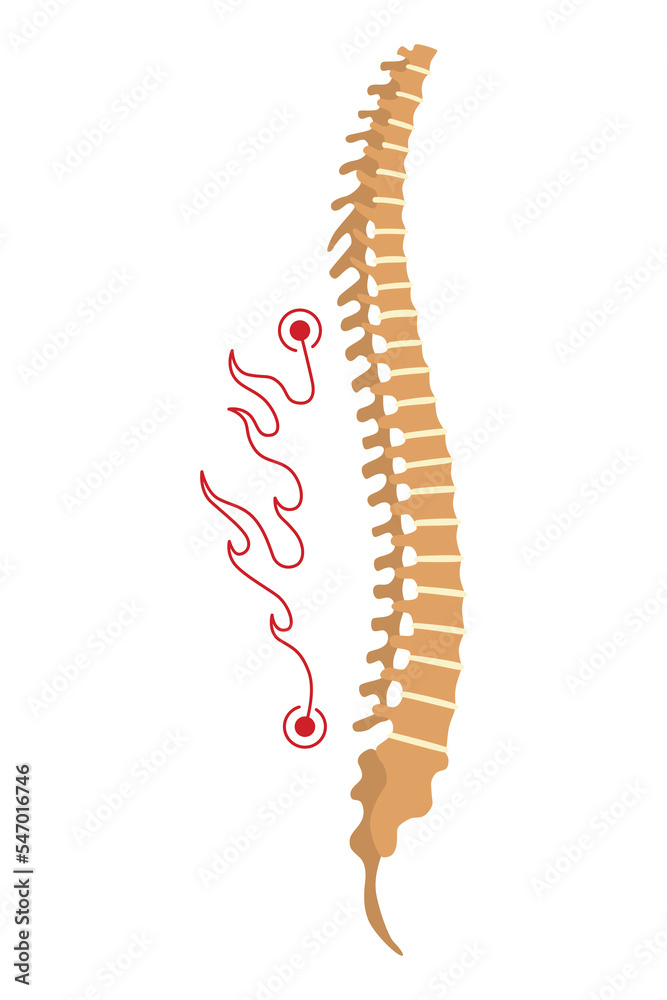 Spinal deformity. Symbol of spine curvatures or unhealthy backbones ...