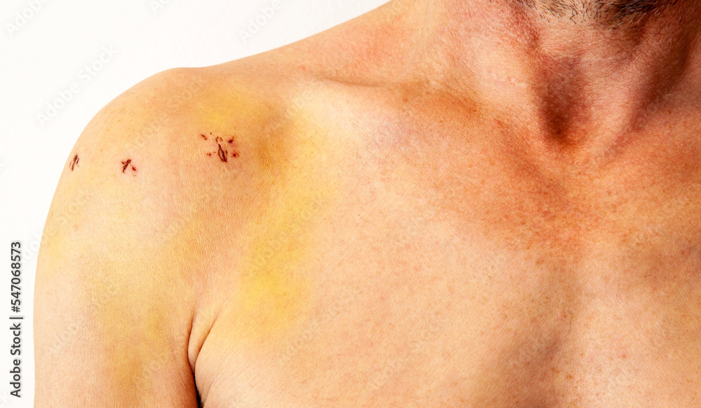 Male shoulder with scars after shoulder Arthroscope surgery. Chronic ...