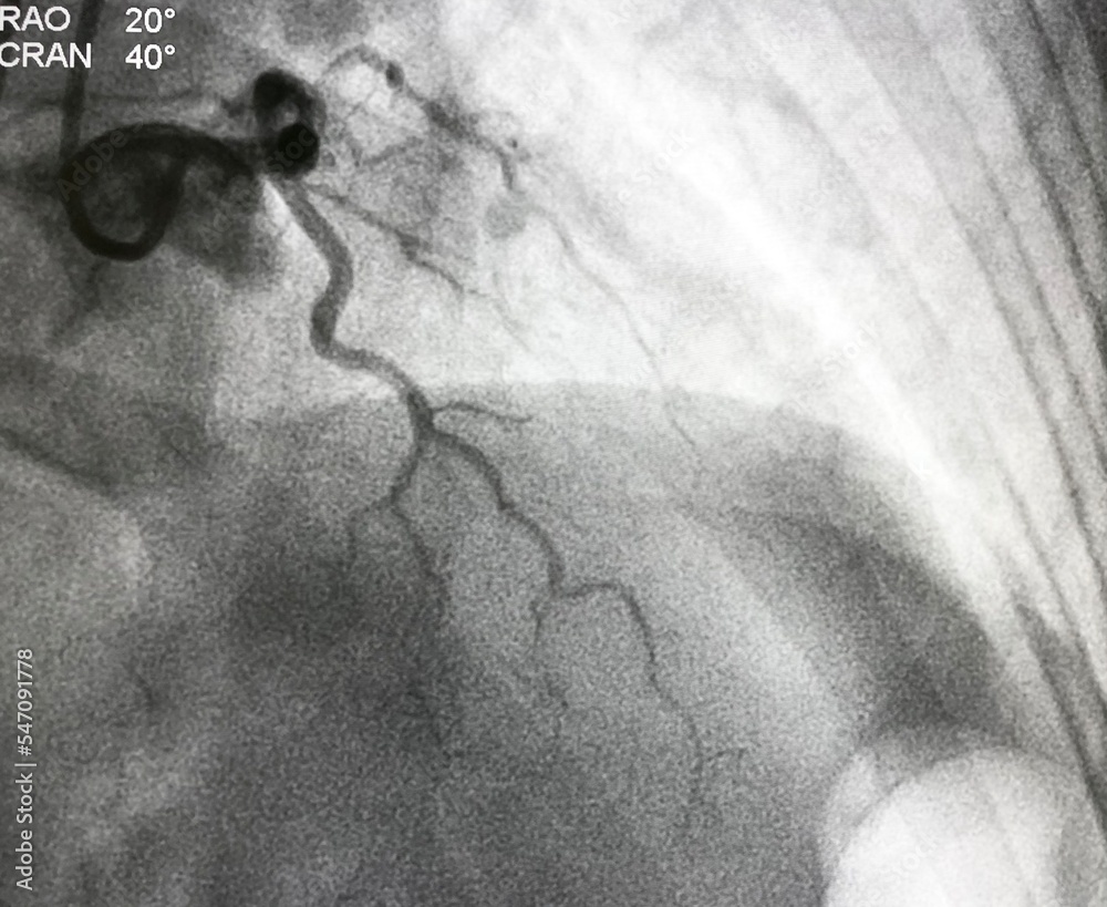 coronary angiogram shown massive thrombus that occluded left anterior ...