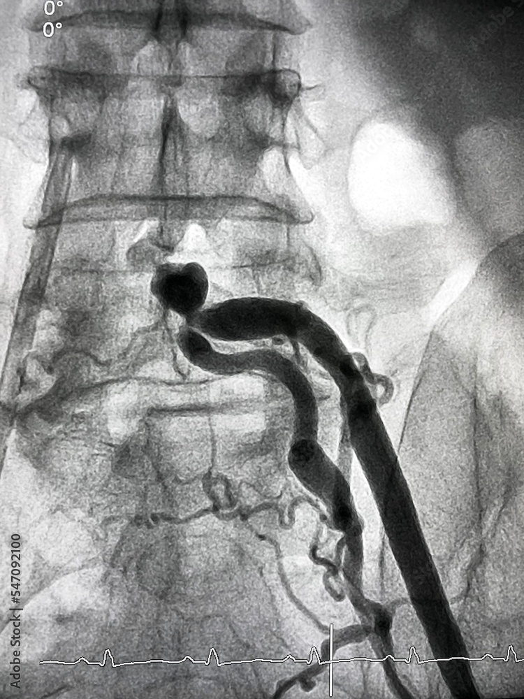 Angiogram shown left femoral artery stenosis during cardiac ...