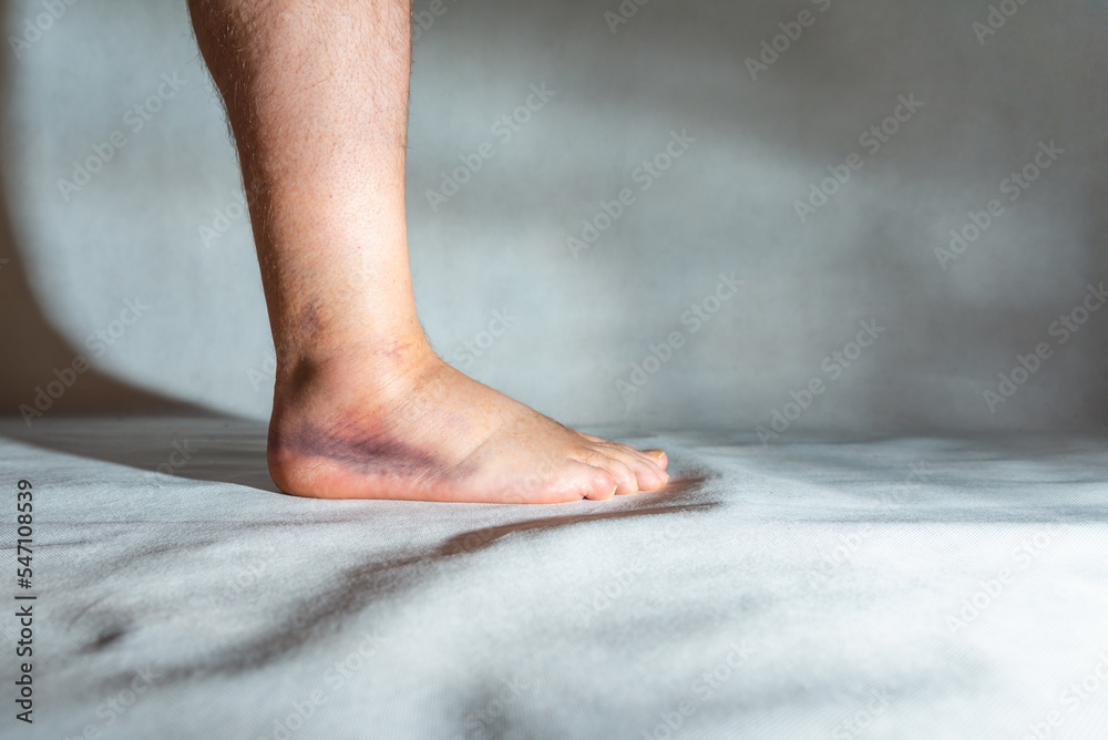 Sprained and swollen ankle.Mans sprained ankle at home.Ankle sprain ...