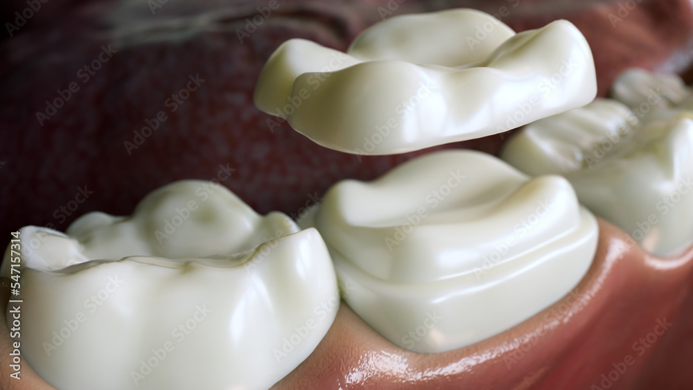 Ceramic Overlay crown over a tooth- 3D Rendering Stock Illustration ...