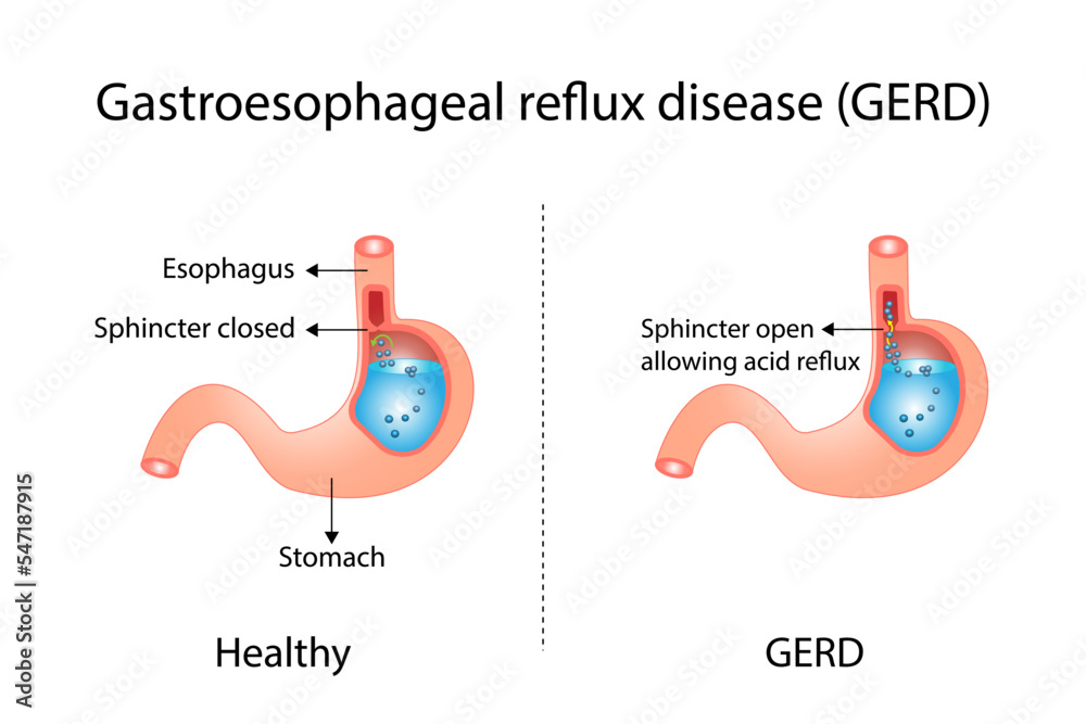 Vetor de Gastroesophageal Reflux Disease (GERD), Heartburn. Heartburn ...