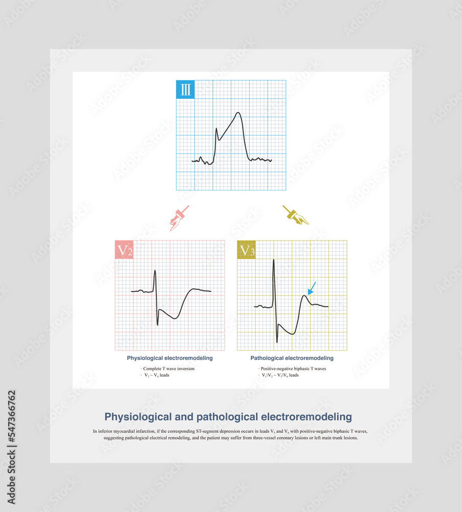 In acute inferior myocardial infarction, pathological electrical ...