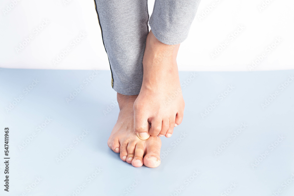 Itchy feet, foot fungus, close-up of an itchy woman with her thumb ...
