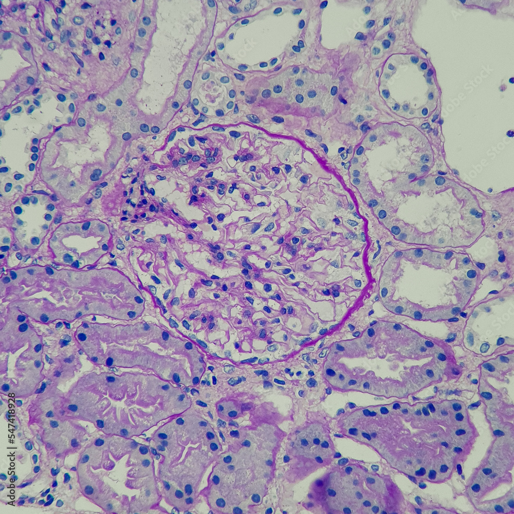 Camera photo of normal glomeruli and renal tubules, PAS stain ...