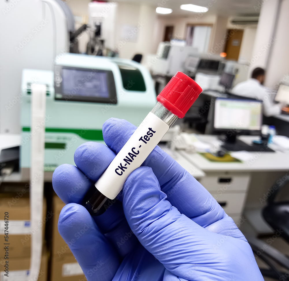 Blood test sample for CK NAC activity test, sensitive marker for the ...