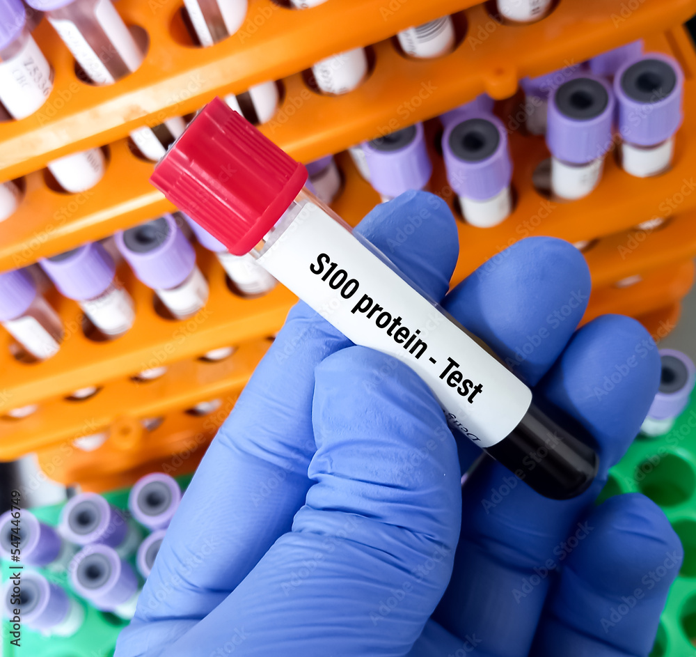 Blood sample for S-100 protein test, for disease monitoring in ...