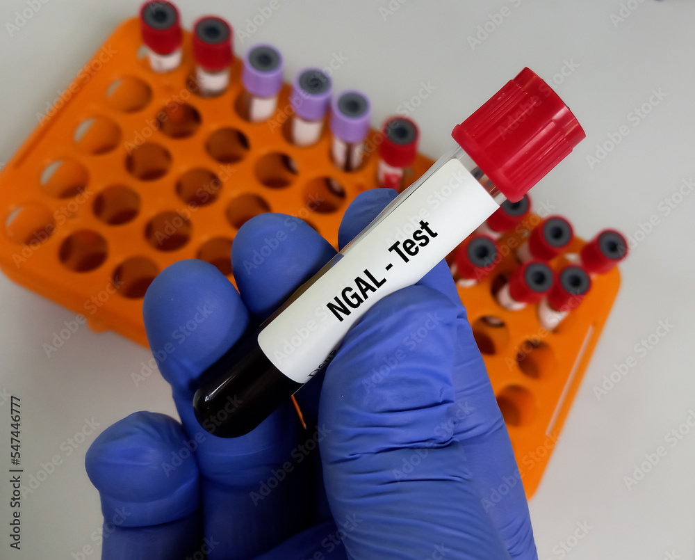 Blood sample for NGAL(Neutrophil gelatinase-associated lipocalin) test ...