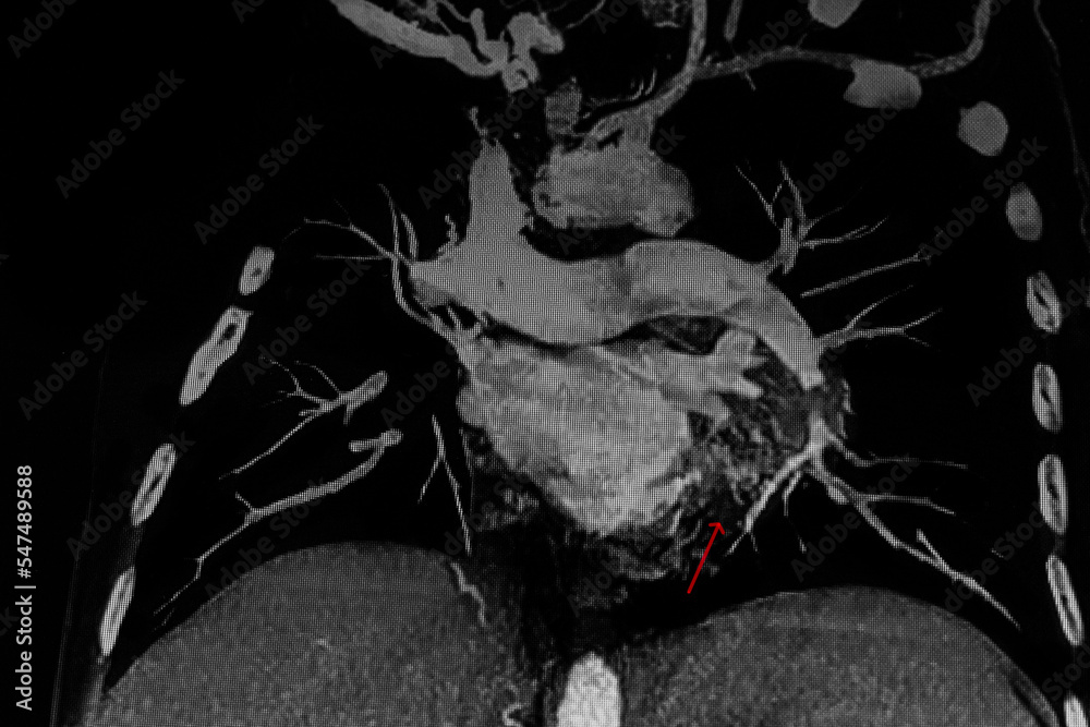 Poster CAT Scan image pulmonary angiography showing lung adenocarcinoma with red arrow – Wall ...