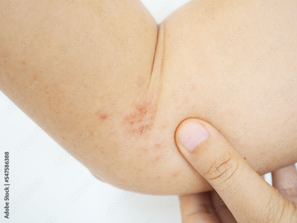 Herpes zoster or shingles symptoms on arm woman. Stock Photo | Adobe Stock