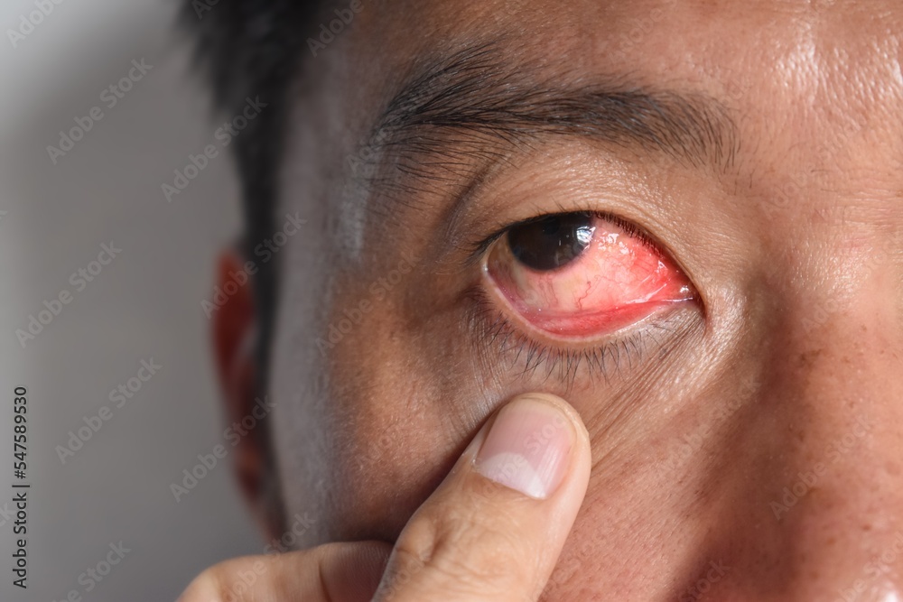 Corneal infection or ulcer called keratitis in Asian Chinese man. Stock ...