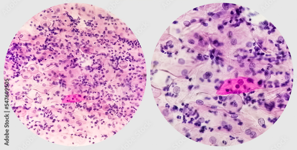 Photo collage of Paps smear. Microscopic examination of pap smear ...