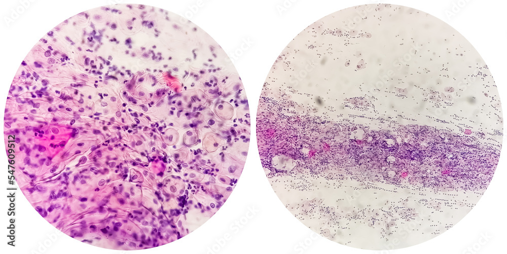 Photo collage of Paps smear. Microscopic examination of pap smear ...
