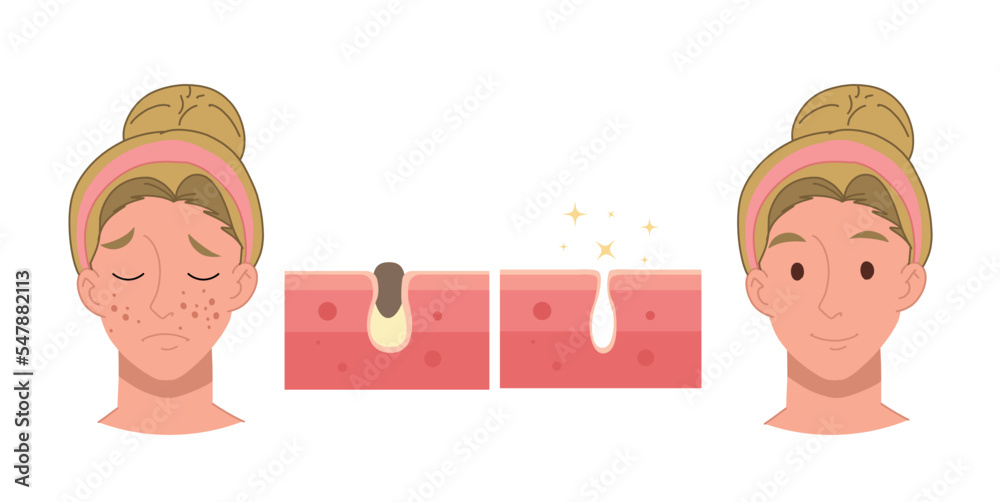 Acne treatment before after concept, facial cleansing foam, Vector ...