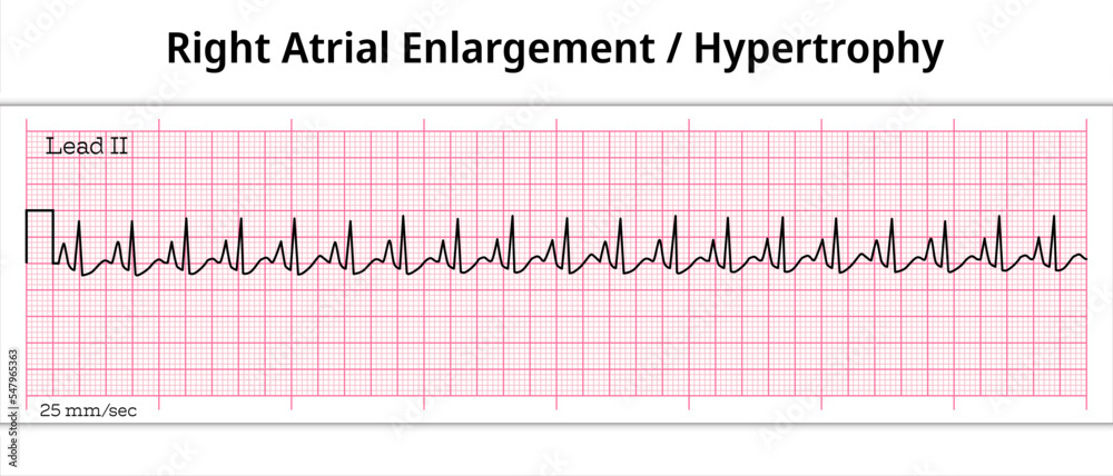 Ecg Right Atrial Enlargement 8 Second Ecg Paper Right Atrial Hypertrophy Stock Vector