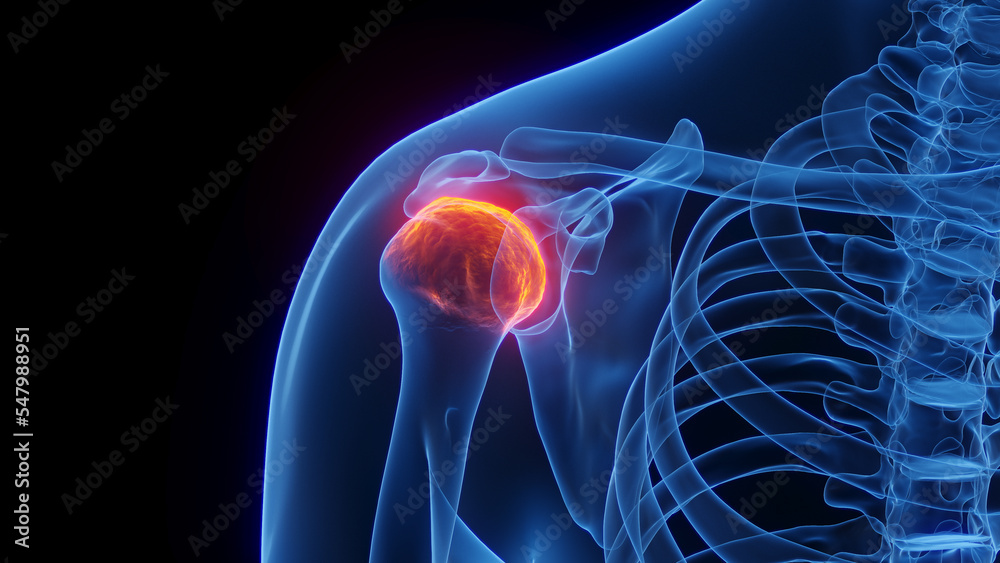 3D rendered Medical Illustration of Male Anatomy - Inflamed Shoulder ...