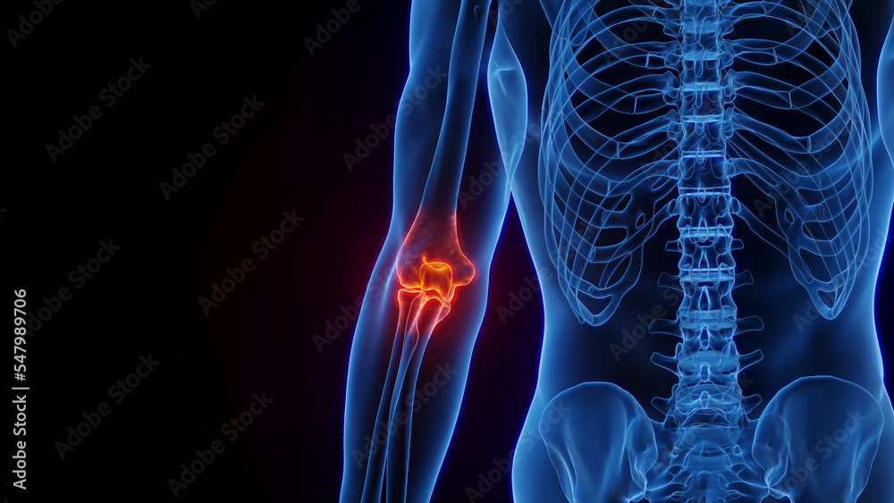 3D rendered Medical Illustration of Male Anatomy - Inflamed Elbow ...