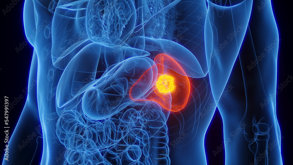 3D Rendered Medical Illustration of Male Anatomy - Splenic Cancer ...