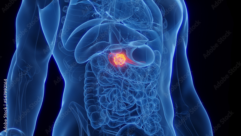 3D Rendered Medical Illustration of Male Anatomy - Pancreatic Cancer ...