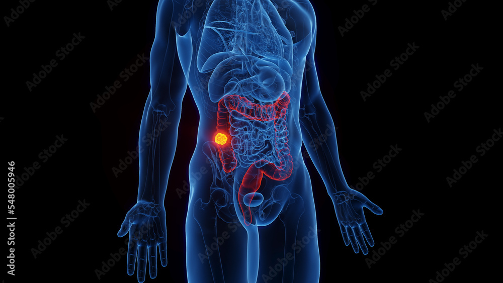 3D Rendered Medical Illustration of Male Anatomy - Colon Cancer ...