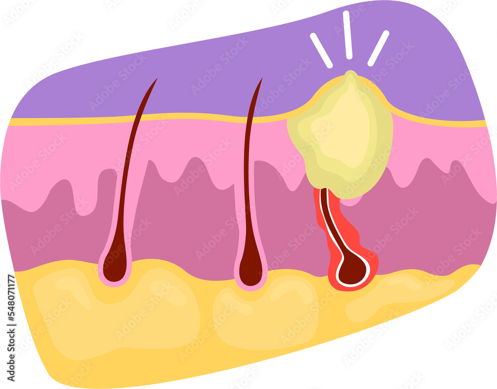 Pimple with ingrown hair 2D raster isolated illustration. Swollen bump ...