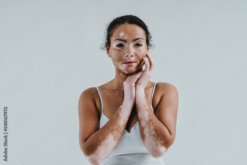 Beautiful woman with vitiligo skin posing in studio. Concept about body ...