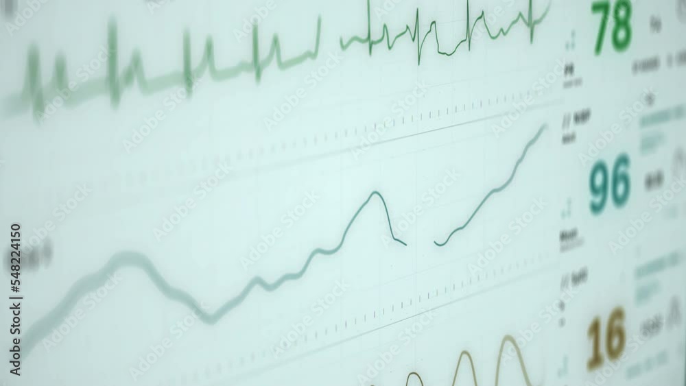 Showing the heartbeat graph during the cardiac test. Analysing the ...