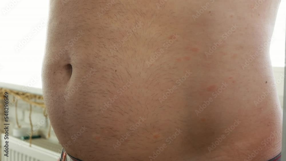 Allergic area of the skin. Allergic rash on the skin close-up. Allergy ...