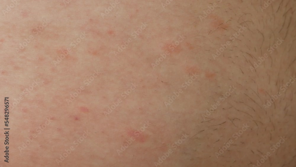 Allergic area of the skin. Allergic rash on the skin close-up. Allergy ...