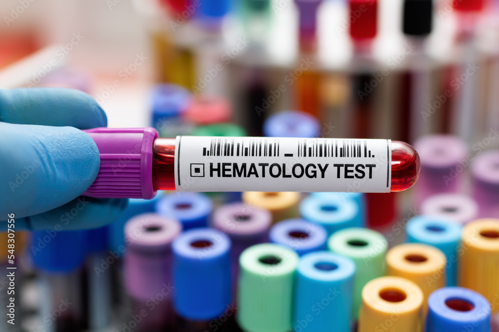 Blood drawn from a patient for diagnostic in the hematology lab. Lab ...