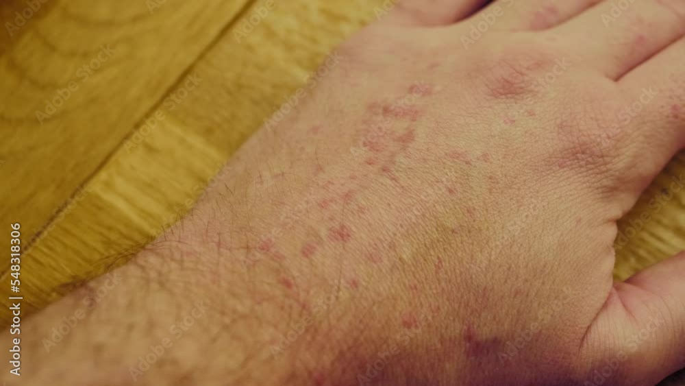 Food Allergy, Lot of red spots or rash on the skin all of a man hand ...