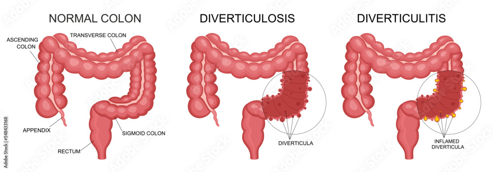 Diverticulitis and diverticulosis vector illustration. Medical ...