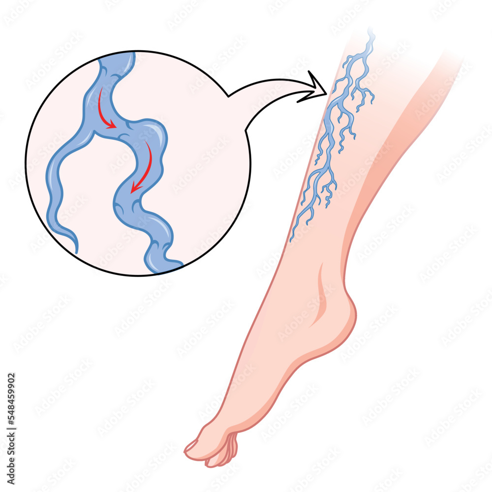 Varicose veins. Blue blood vessel visible through the skin, abnormally ...