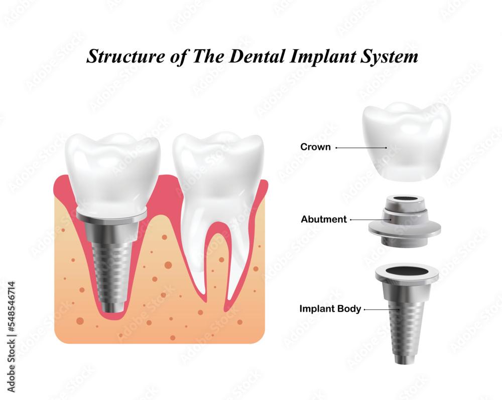 Structure of The Dental Implant System Stock Vector | Adobe Stock