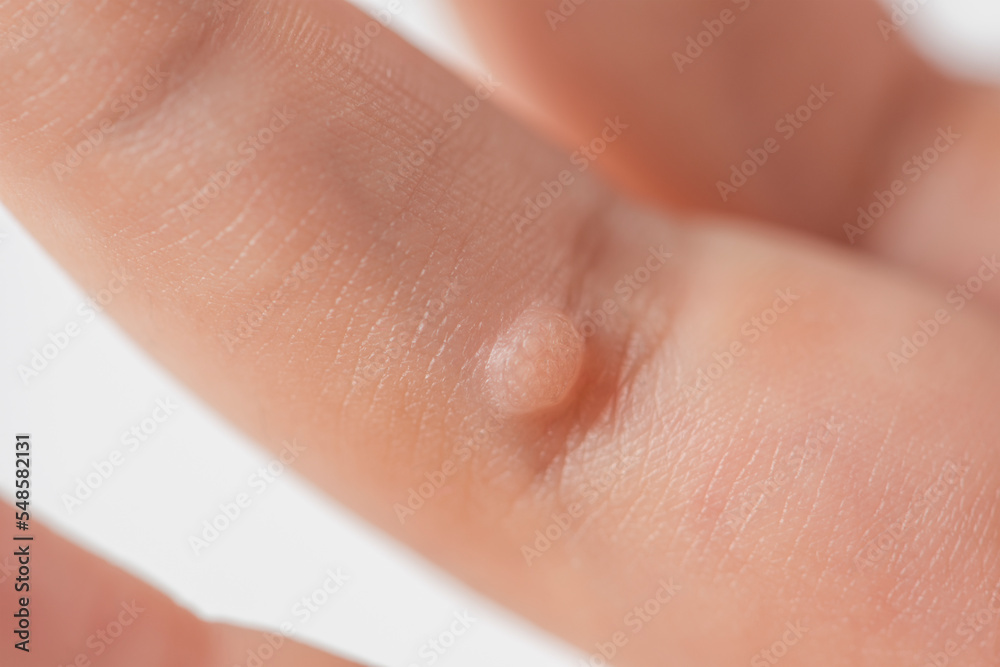 Wart on the finger. Close-up of a wart on a child's finger. The common wart Verruca vulgaris is ...