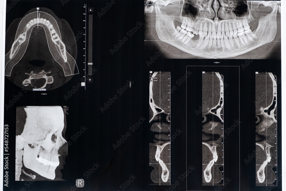 CT scan of a patient with malocclusion, missing chewing tooth and ...