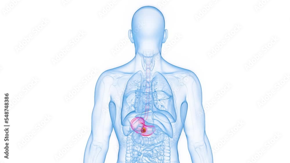 Vidéo Stock 3d rendered medical animation of a neoplastic growth in the ...