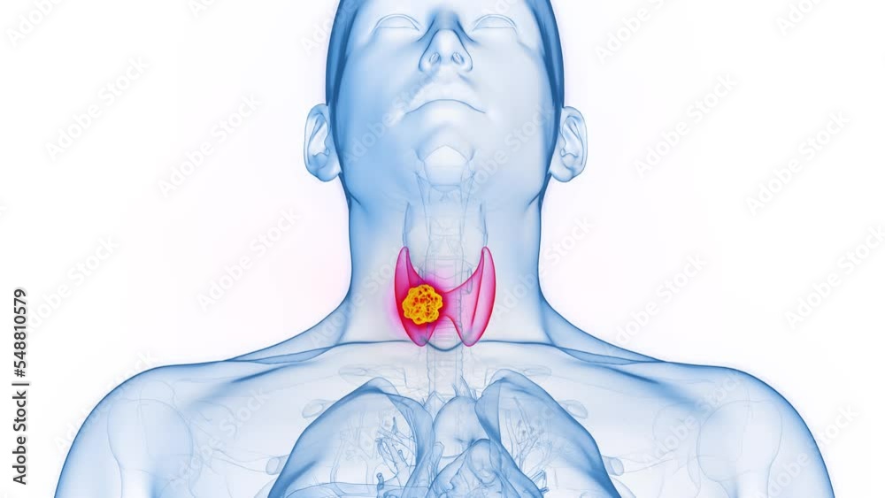 3d rendered medical animation of thyroid cancer in a man's right ...